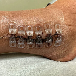 Scar Therapy Program - Patients - BRIJ Medical