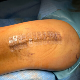 Scar Therapy Program - Patients - BRIJ Medical