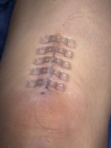 Meet Brijjit® | Offload tension. Optimize healing.